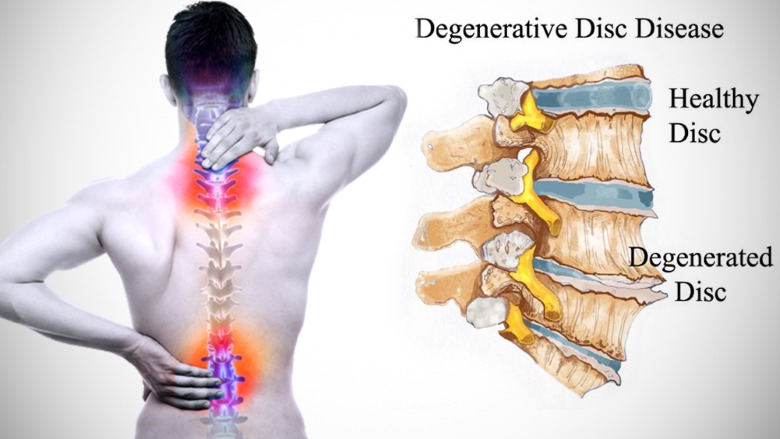 Degenerative Disk | Home